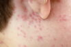Chickenpox: symptoms, treatment and potential complications - The ...