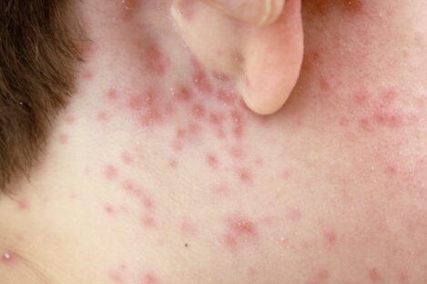 Chickenpox: symptoms, treatment and potential complications - The ...
