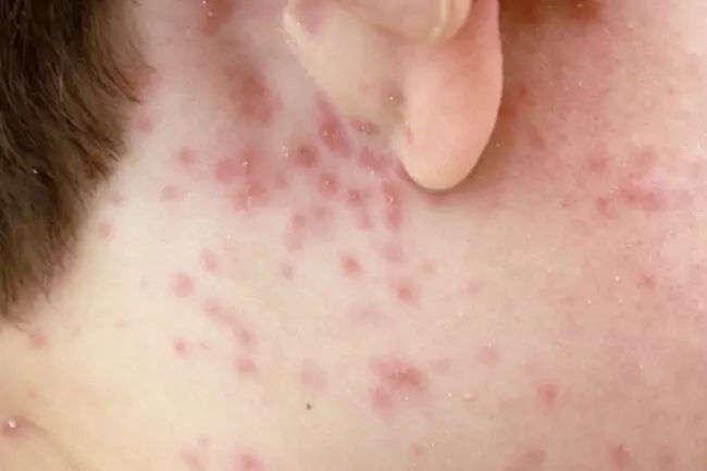 Chickenpox: symptoms, treatment and potential complications - The ...