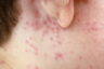 Chickenpox: symptoms, treatment and potential complications - The ...