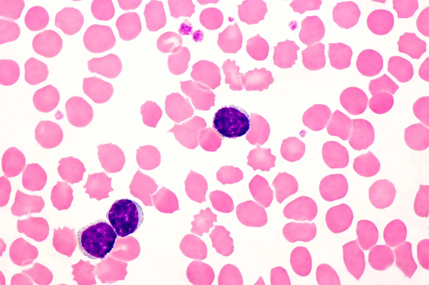 Chronic lymphocytic leukaemia: diagnosis and management - The ...