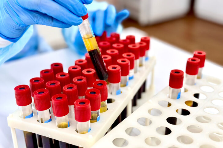 NICE approves gene-editing sickle cell therapy for NHS in England - The ...
