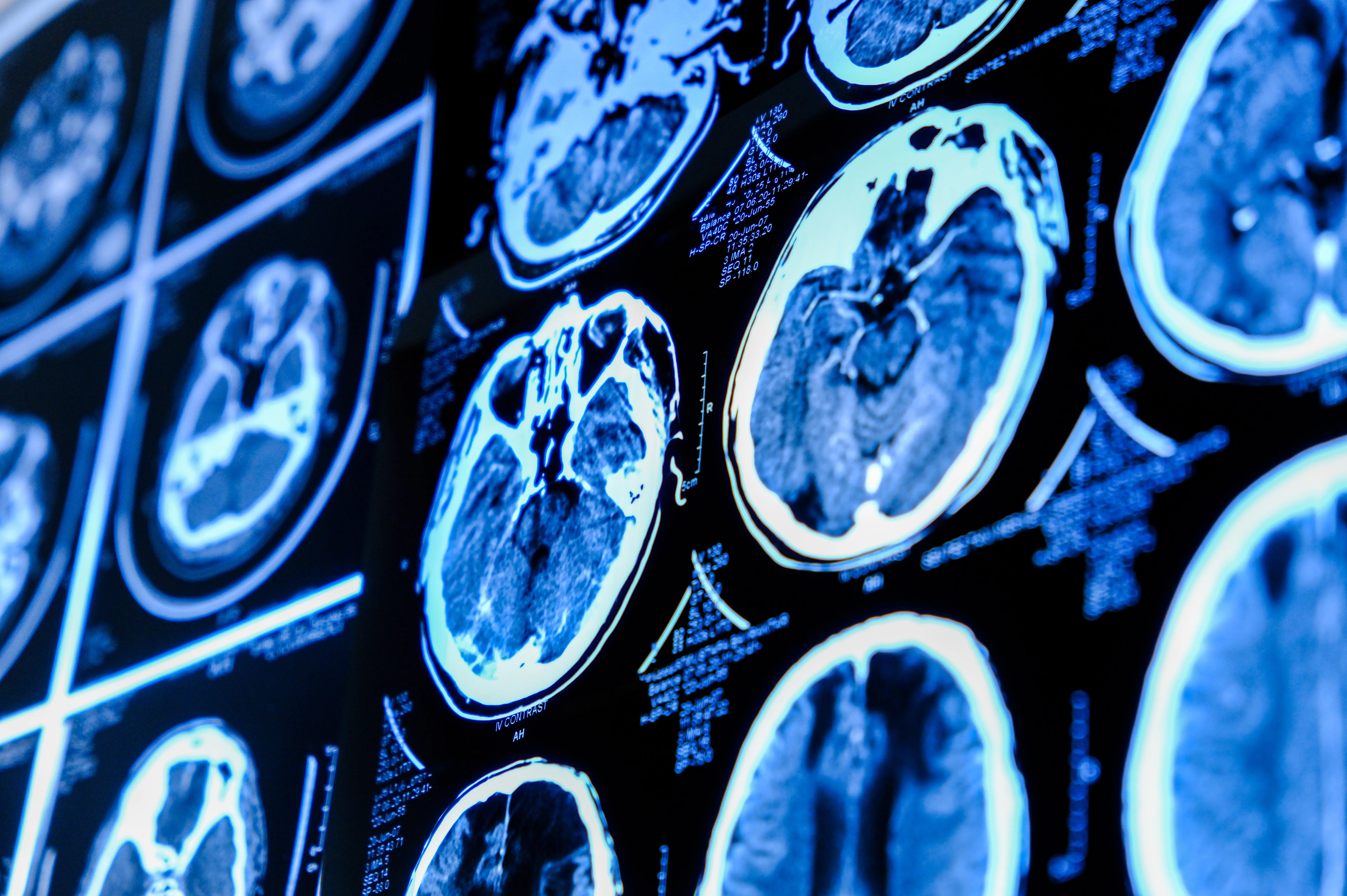 Alzheimer's treatments donanemab and lecanemab still not recommended ...