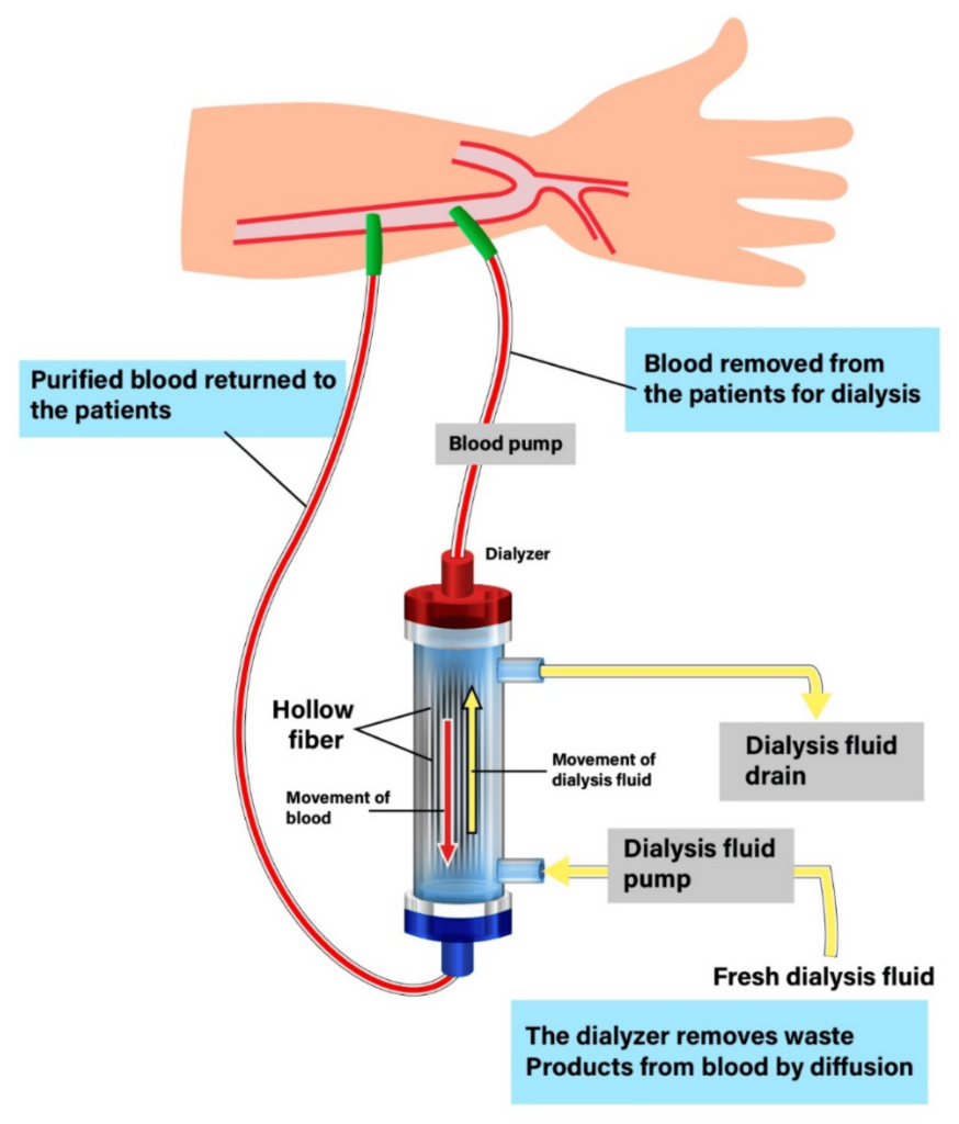 Haemodialysis and peritoneal dialysis: an overview - The Pharmaceutical ...