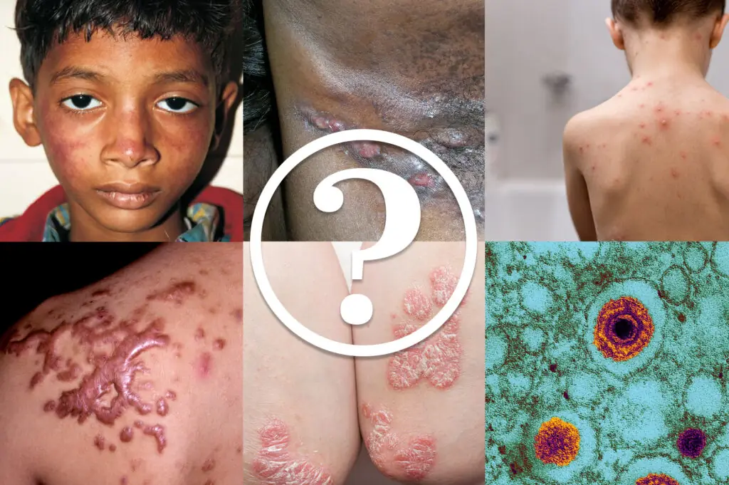Test your knowledge of dermatological conditions - The Pharmaceutical ...