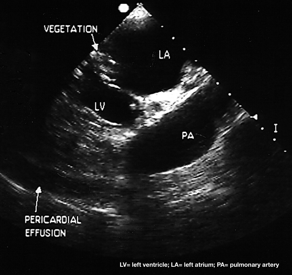 Infective endocarditis caused by Staphylococcus aureus - The ...