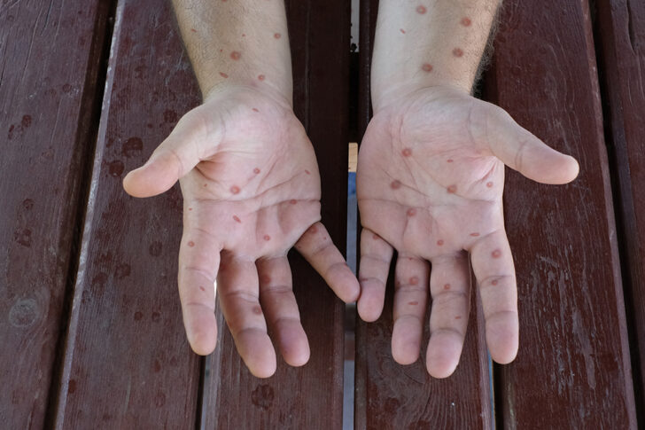 Mpox vaccinations pushed as clade Ib identified in Europe - The ...
