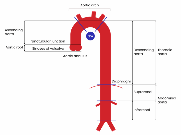 Diagnosis and management of aortic disorders - The Pharmaceutical Journal