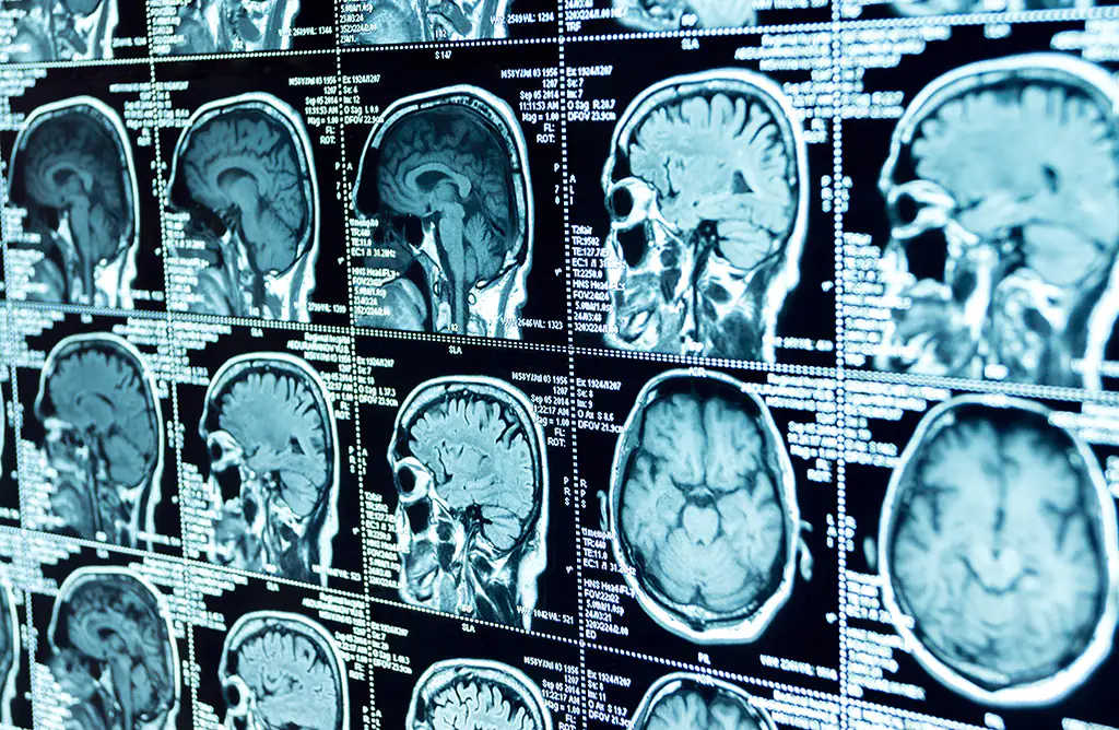 Amyloid-targeting Alzheimer's drugs ‘probably’ not effective - The ...